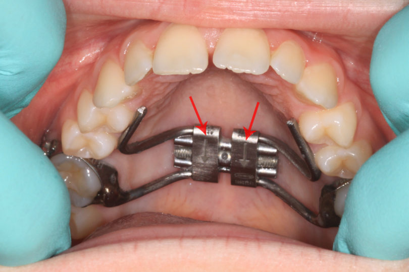 Expander - Bridgham Barr Orthodontics